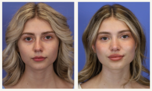 Nose Job Utah: Safety, Risks, and What to Expect from Consultation — Dr ...